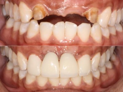 Dentist in Chicago, IL - Smile Gallery West Loop Smile Studio | Before ...