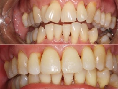 Dentist in Chicago, IL - Smile Gallery West Loop Smile Studio | Before ...